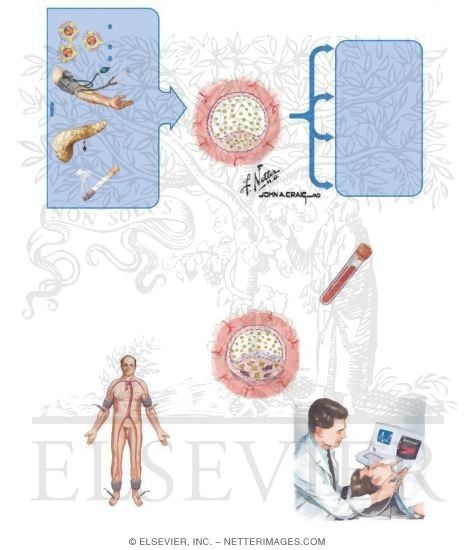 Cardiovascular Risk Prediction