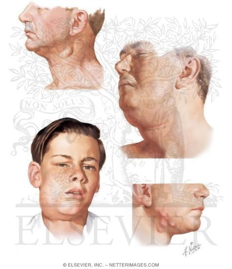 Neck Masses In Adults
