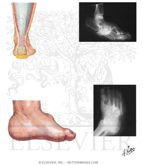 Disorders of the Foot and Ankle