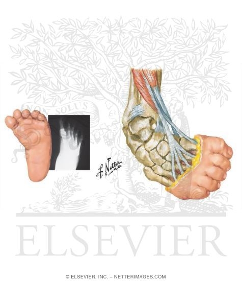 Pediatric Disorders of the Foot and Ankle