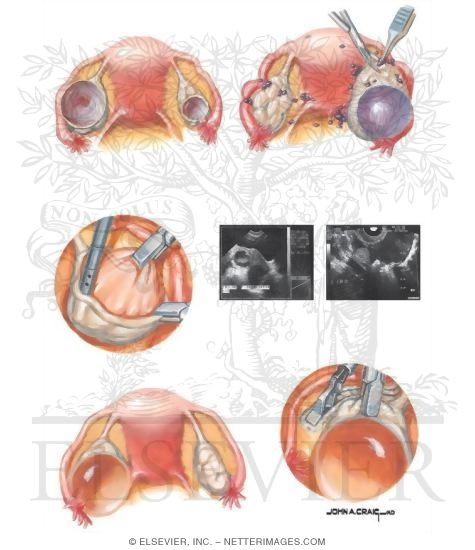 Management Options For Pelvic Mass