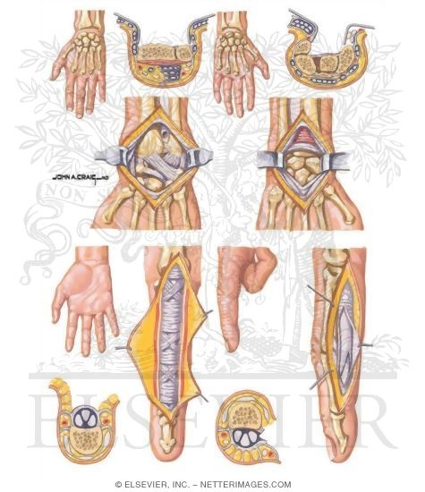 Surgical Approaches to Hand and Finger