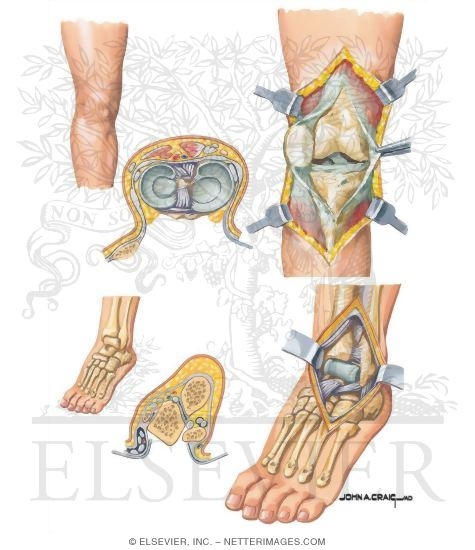 Surgical Approaches to the Ankle