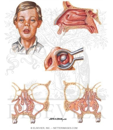 Causes of Sinus Obstruction