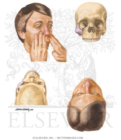 broken zygomatic bone