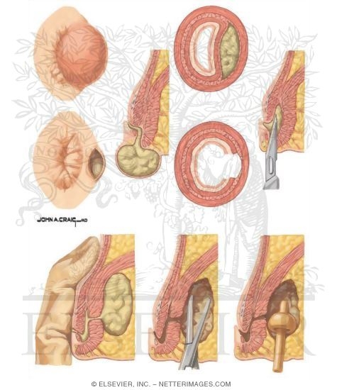 anorectal abscess