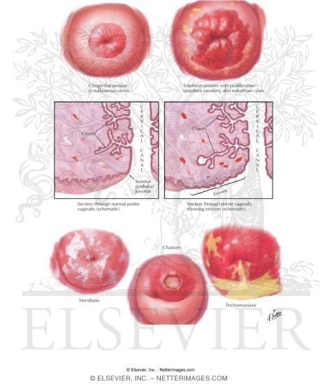 cervicitis with ectropion