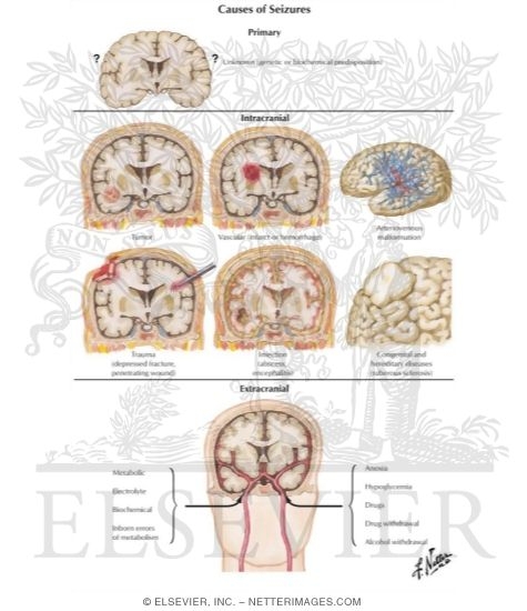 Causes of Seizures