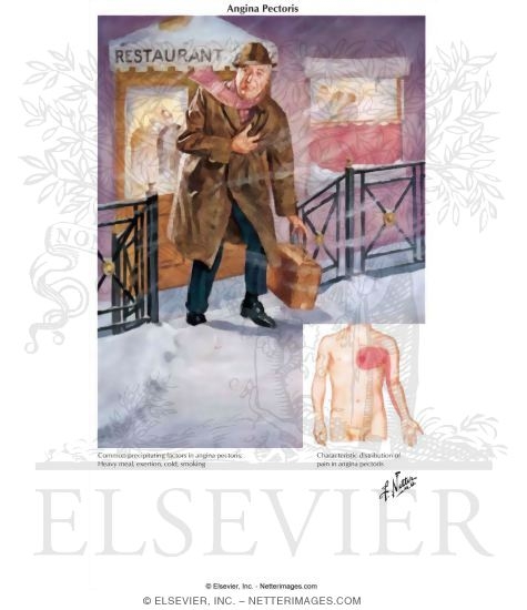 Angina Pectoris