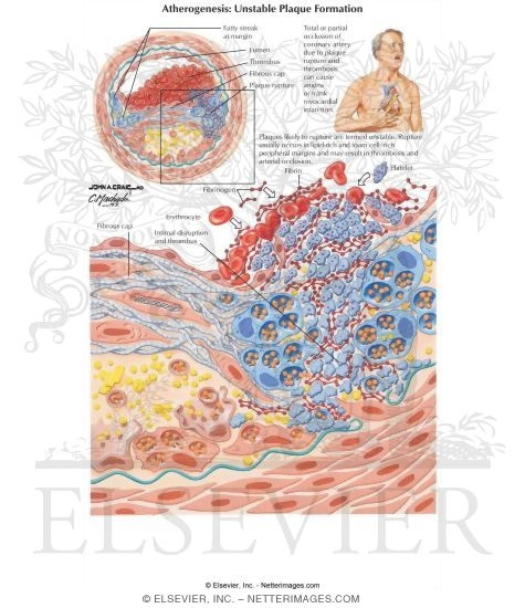 Atherogenesis: Unstable Plaque Formation