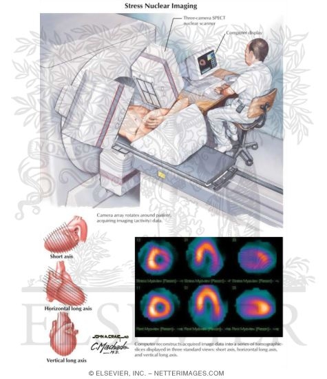 Stress Nuclear Imaging