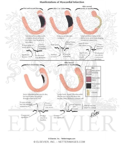 Manifestations of Myocardial Infarction