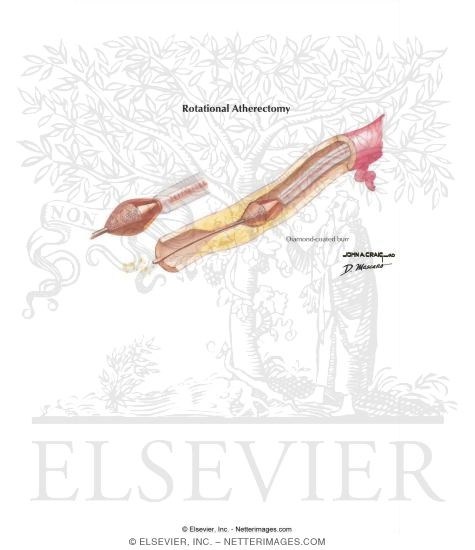 Rotational Atherectomy
