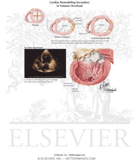 Cardiac Remodeling Secondary to Volume Overload