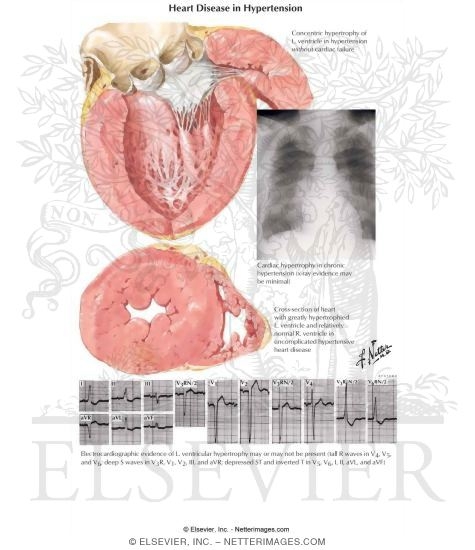 Heart Disease in Hypertension
