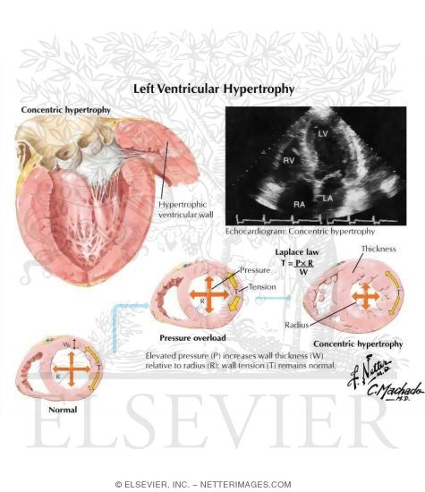 Left Ventricular Hypertrophy Left Ventricular Hypertrophy