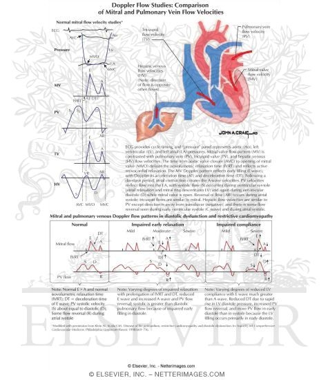 Doppler Flow Studies: Comparison of Mitral and Pulmonary Vein Flow ...