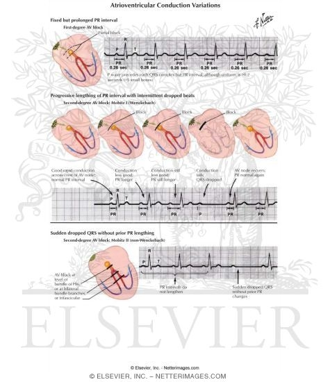 Atrioventricular Conduction Variations