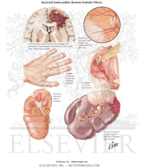 bacterial endocarditis