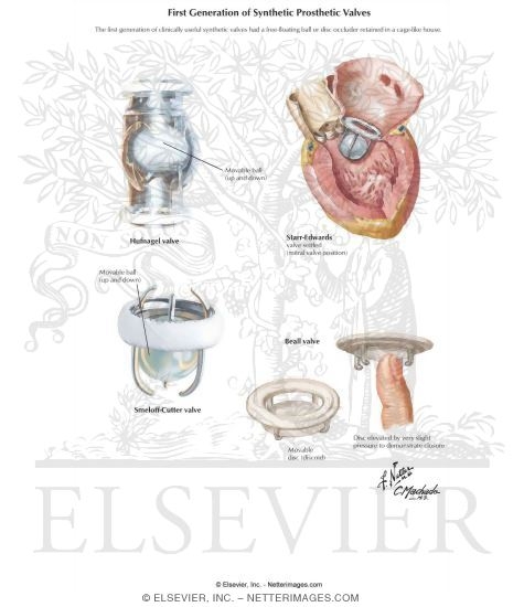 First Generation of Synthetic Prosthetic Valves