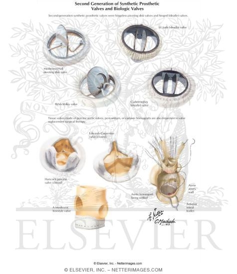 Second Generation of Synthetic Prosthetic Valves and Biologic Valves