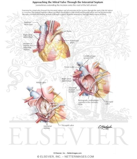Approaching the Mitral Valve Through the Interatrial Septum