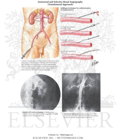 Aortorenal and Selective Renal Angiography (Transfemoral Approach)