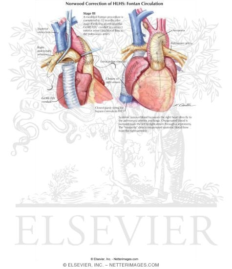 Norwood Correction of HLHS: Fontan Circulation