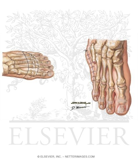 Amputation of Foot
