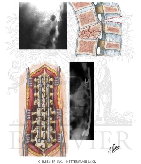 Unstable Fracture of Thoracolumbar Spine
