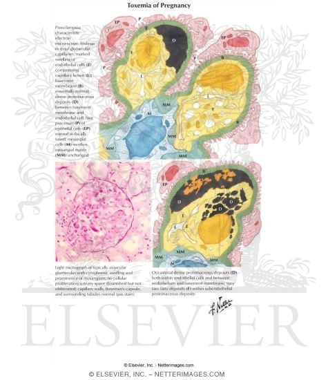 Toxemia of Pregnancy