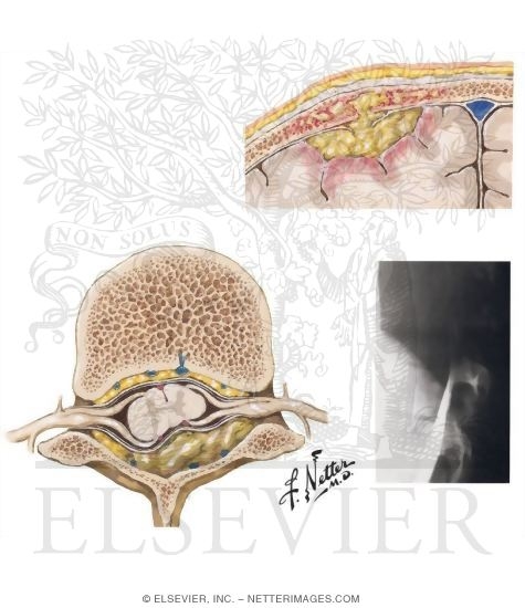 Parameningeal Infections