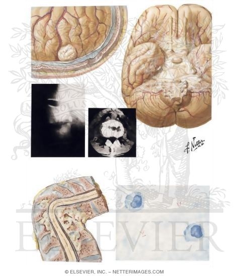 Tuberculosis of Brain and Spine