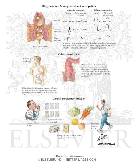 Diagnosis and Management of Constipation
