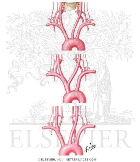 Normal and Anomalous Origins of Common Carotid and Vertebral Arteries