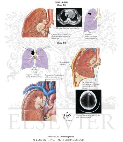 Lung Cancer (Stage IIIA and IIIB)