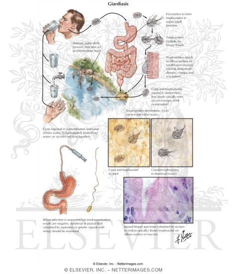Giardiasis