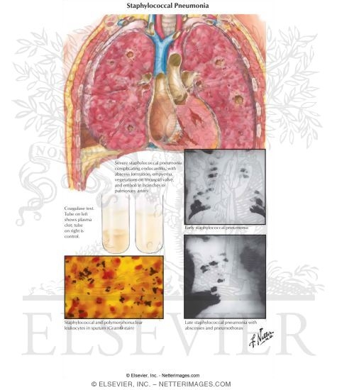Staphylococcal Pneumonia