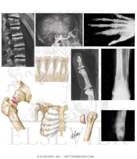 renal osteodydtrophy