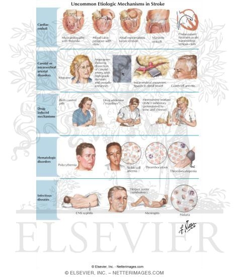 Uncommon Etiologic Mechanisms in Stroke