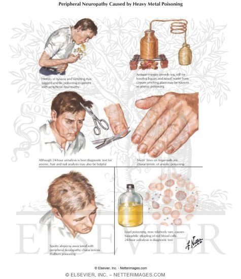 Peripheral Neuropathy Caused by Heavy Metal Poisoning