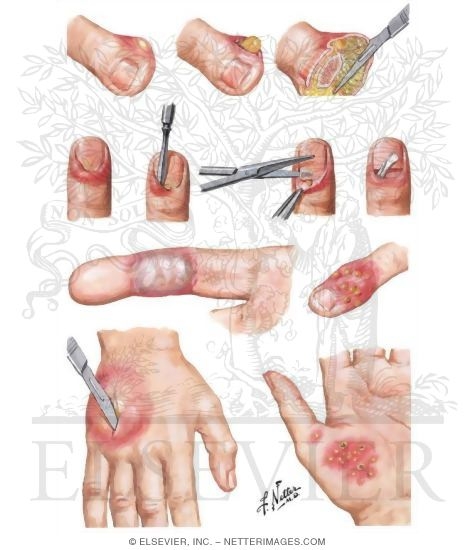 cellulitis hand icd 10