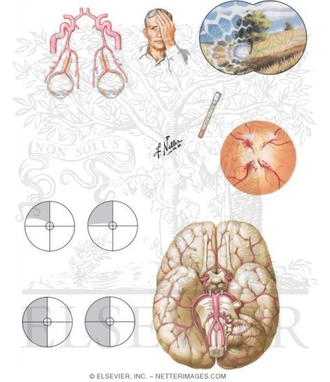 Ocular Signs of Large Vessel Disease