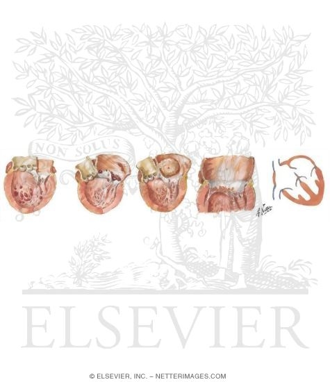 Uncommon Cardiac Mechanisms In Stroke