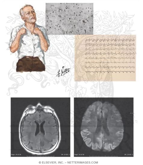Transmissible Spongiform Encephalopathy