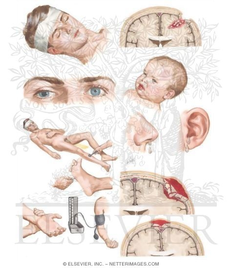 Signs Suggesting Need for Operation In Head Injuries