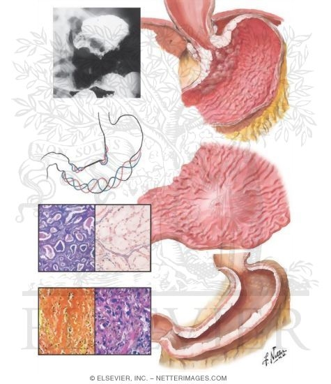 Cancers of the Stomach