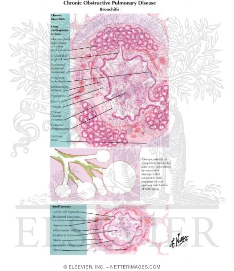 Emphysema Histology Labeled