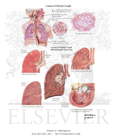 Causes of Chronic Cough