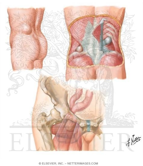 sciatic hernia icd 10